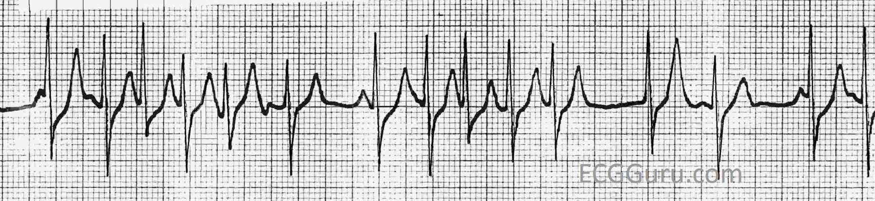 ECG Basics: Multifocal Atrial Tachycardia | ECG Guru - Instructor Resources ECG Basics: Multifocal Atrial Tachycardia | ECG Guru - Instructor Resources